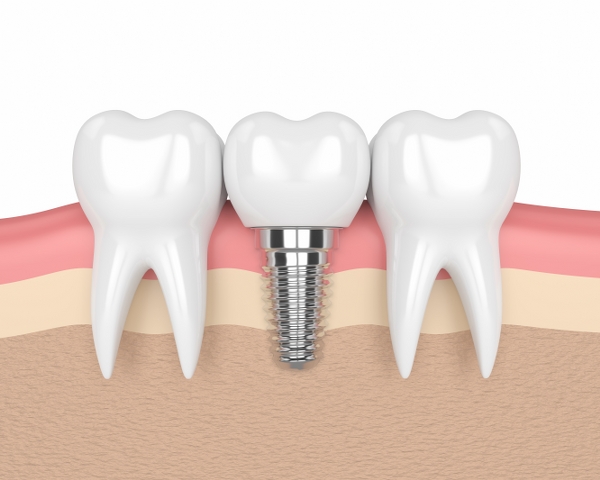 Dental Implants Ashford | Starlite Dental Finberry